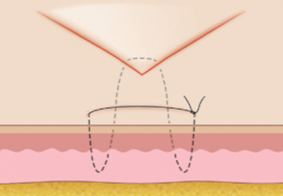 Corner Stitch | Suture.app